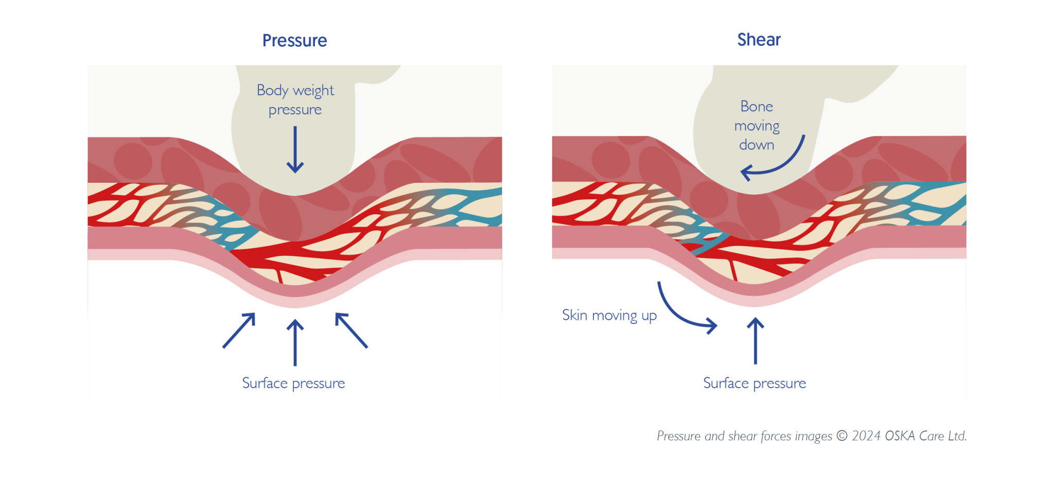 OSKA | Pressure Care Experts