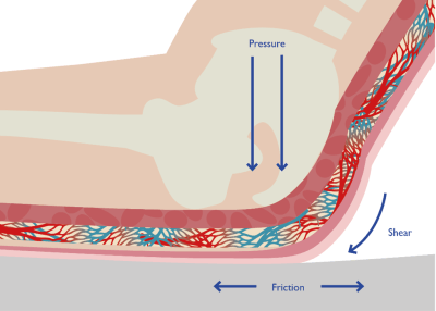 OSKA | Pressure Care Experts